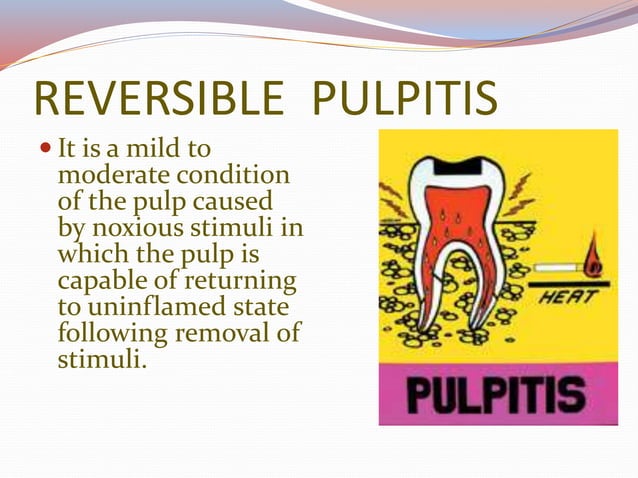 Pulpitis | PPTX | Dental Health | Diseases and Conditions