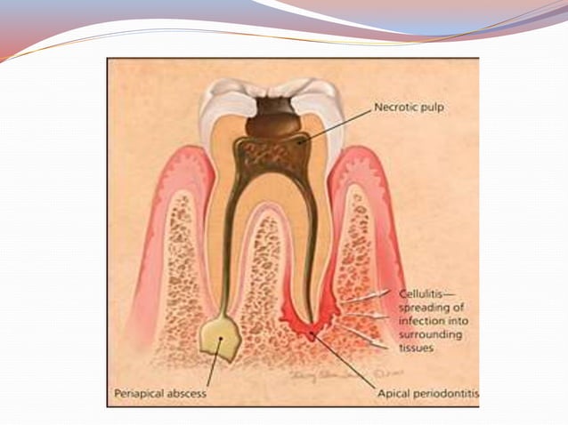 Pulpitis | PPTX | Dental Health | Diseases and Conditions