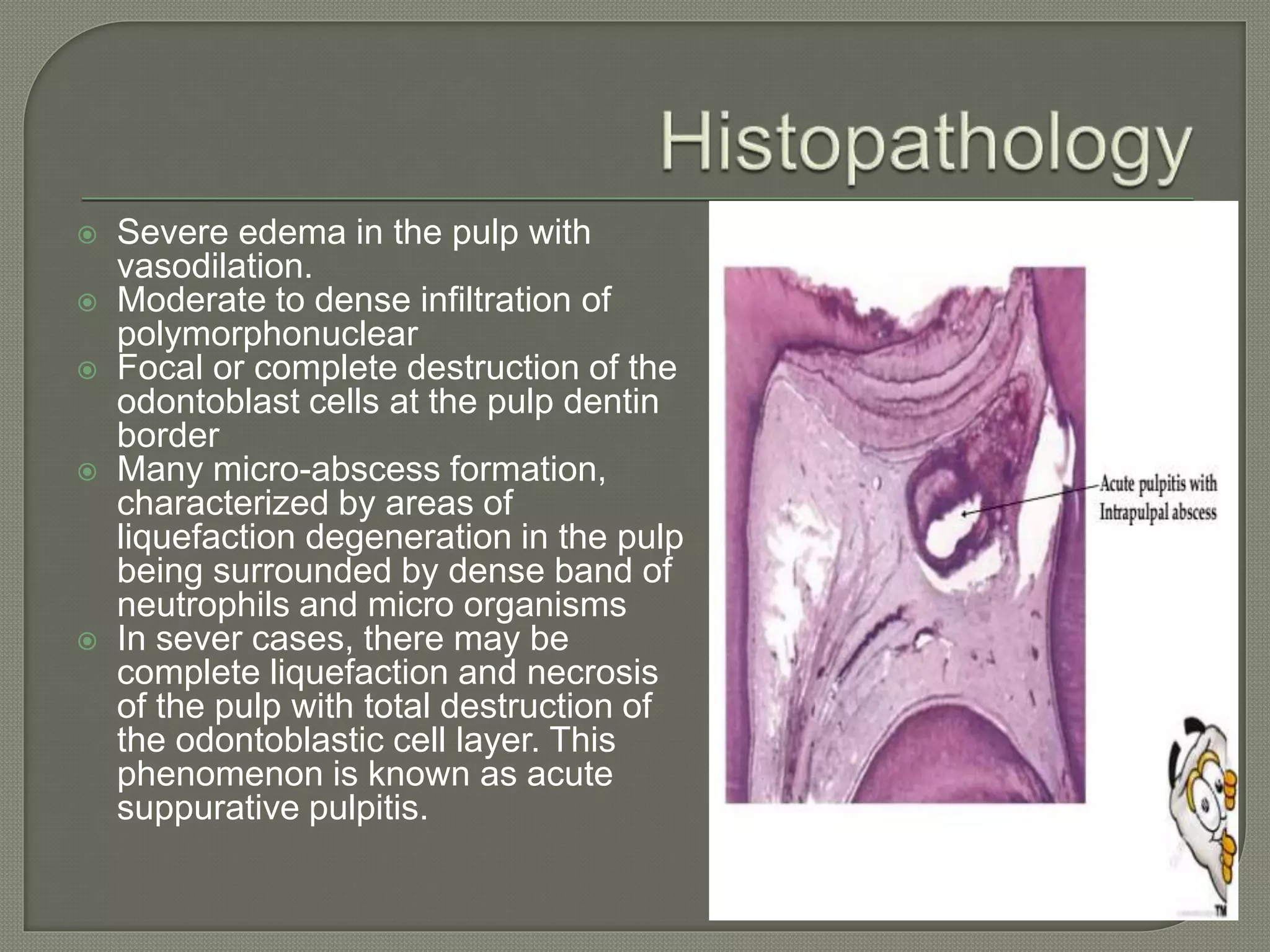 Pulpitis (exam oriented) | PPTX