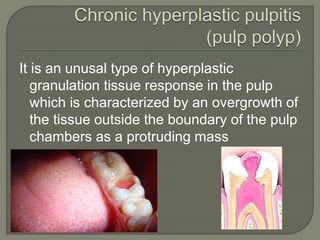 Chronic Hyperplastic Pulpitis