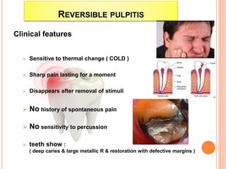Pulpitis | PPTX