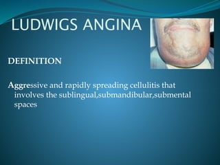 pulpitis and osteomyelitis types and classification.pptx