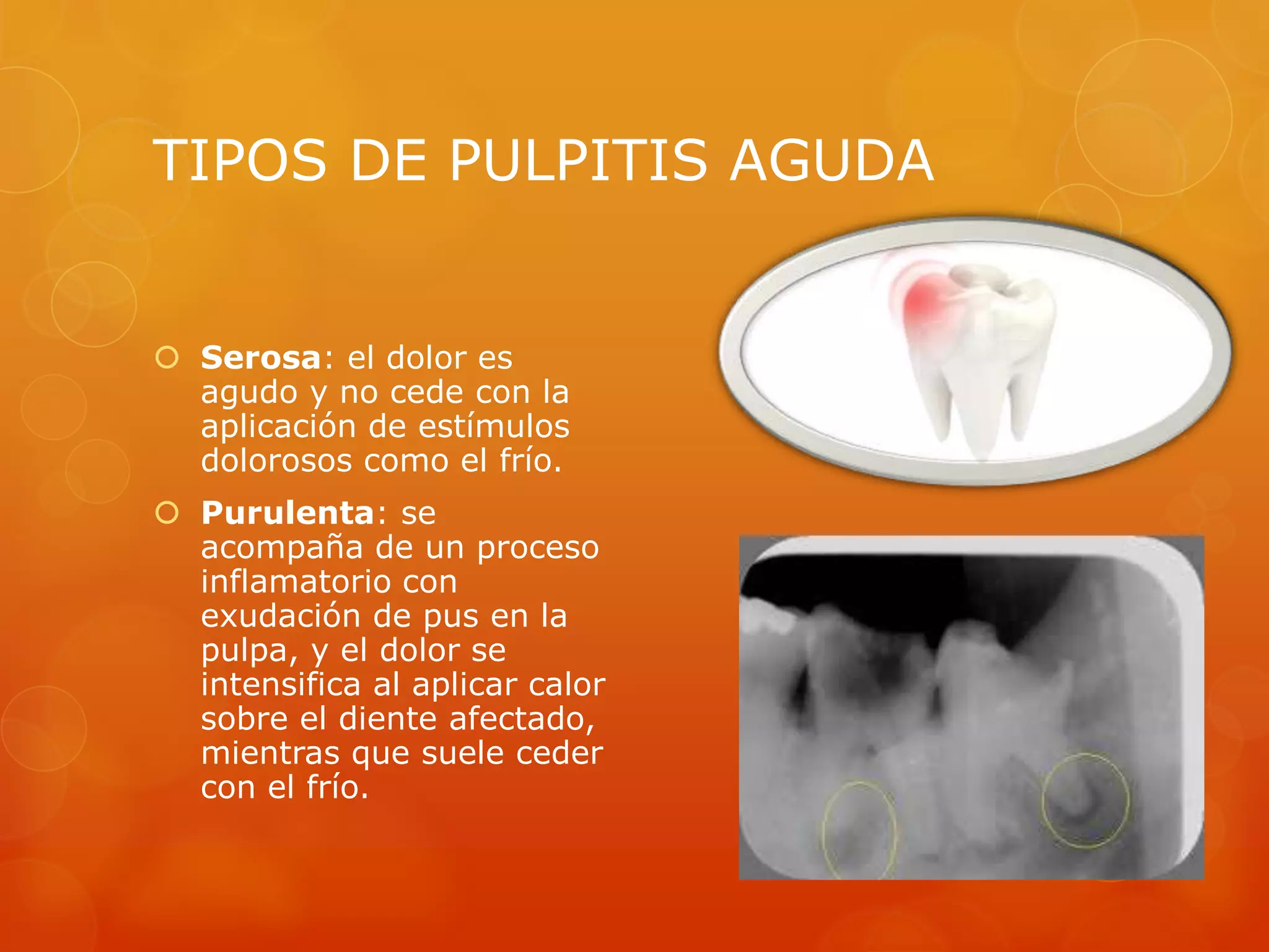 Pulpitis aguda