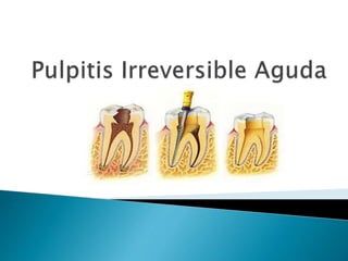 Pulpitis irreversible aguda | PPTX