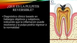 PULPITIS REVERSIBLE.pptx