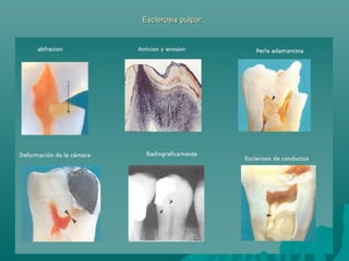 Pulpitis reversible e irreversible | PPT