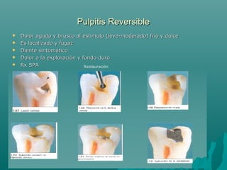 Pulpitis reversible e irreversible | PPT