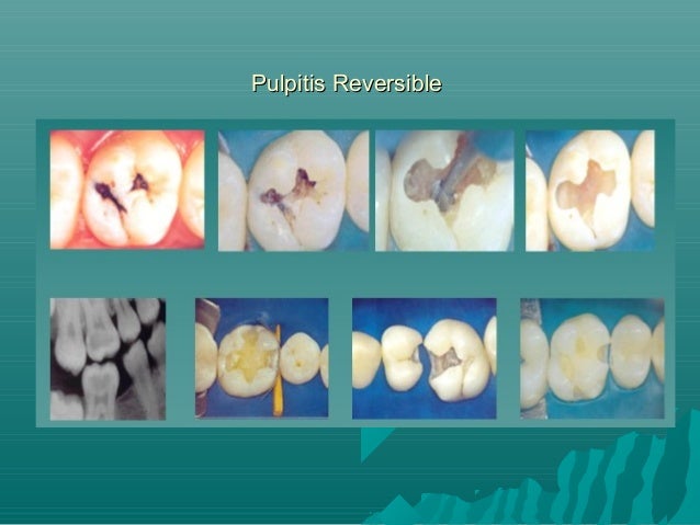 Pulpite Reversível E Pulpite Irreversível Como Diagnosticar – UBQGGK