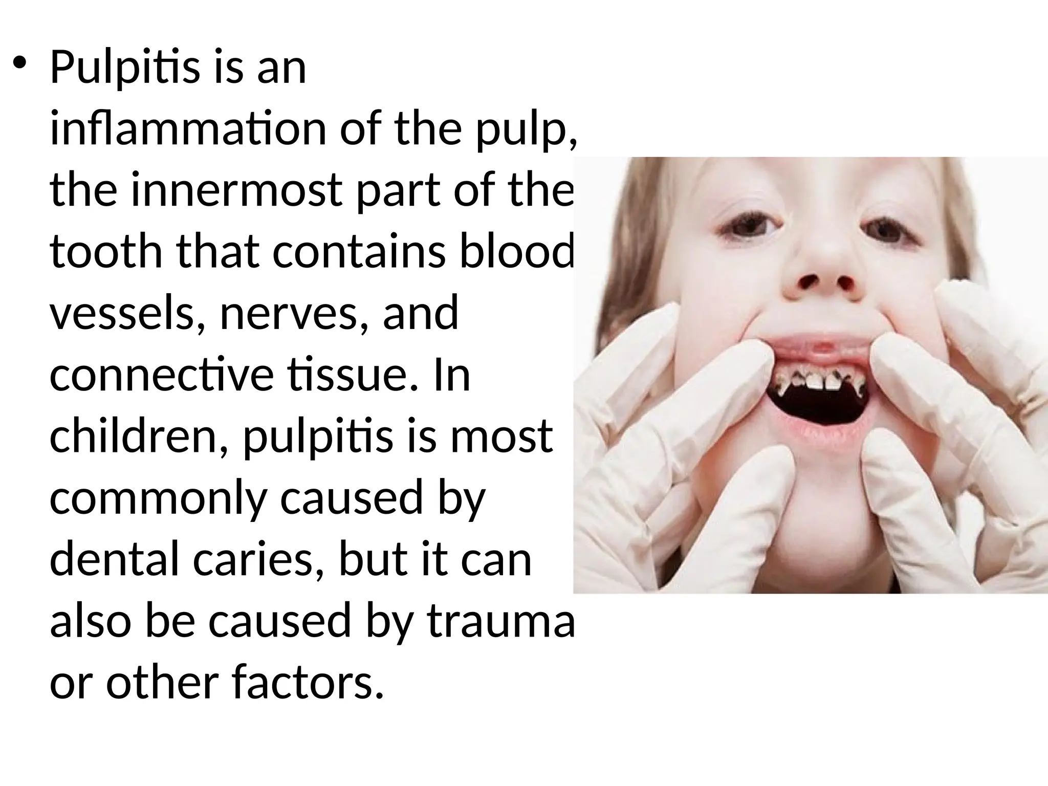 Pulpits in children and it’s symptoms and treatment | PPTX
