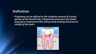 Pulpotomy | PPTX