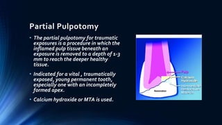 Pulpotomy | PPTX
