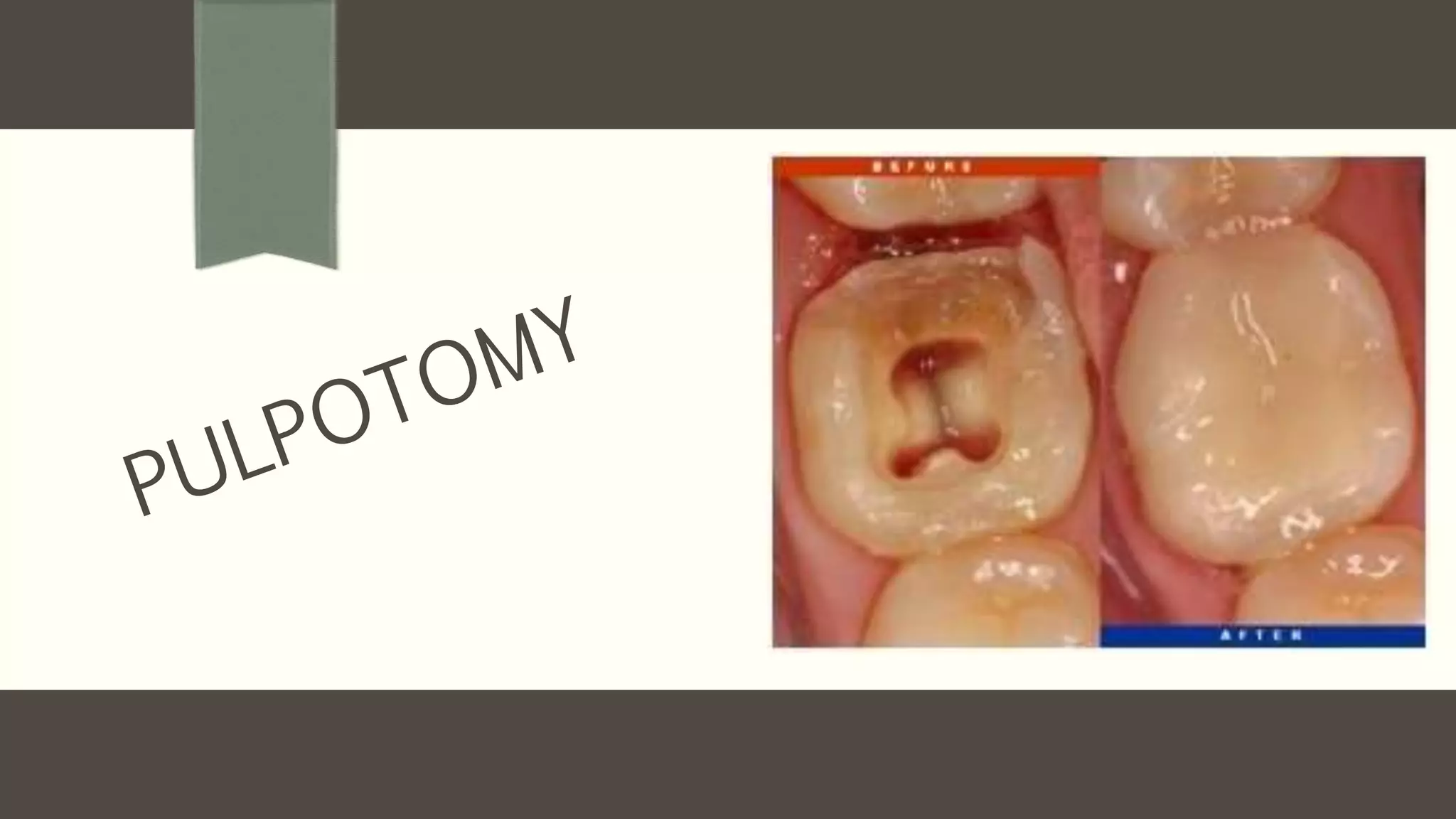 Pulpotomy | PPTX