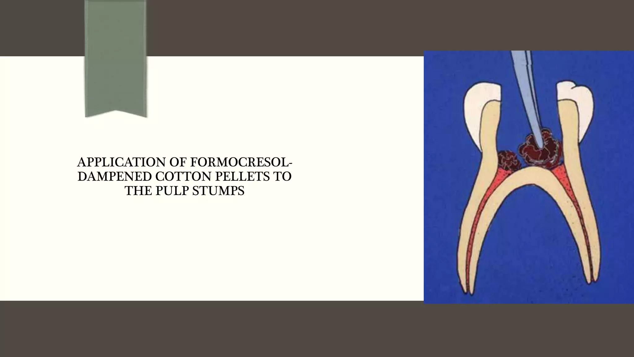 Pulpotomy | PPTX | Dental Health | Diseases and Conditions
