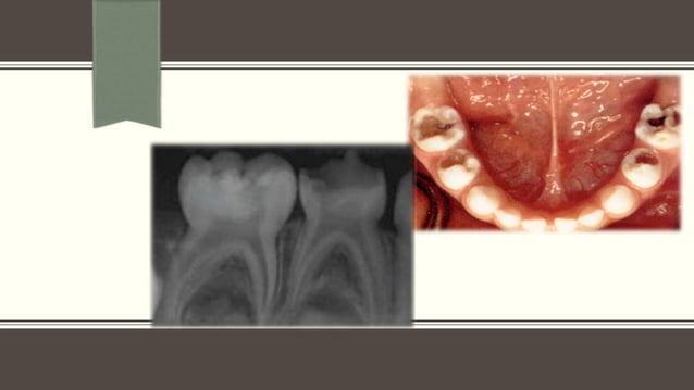 Pulpotomy | PPTX | Dental Health | Diseases and Conditions