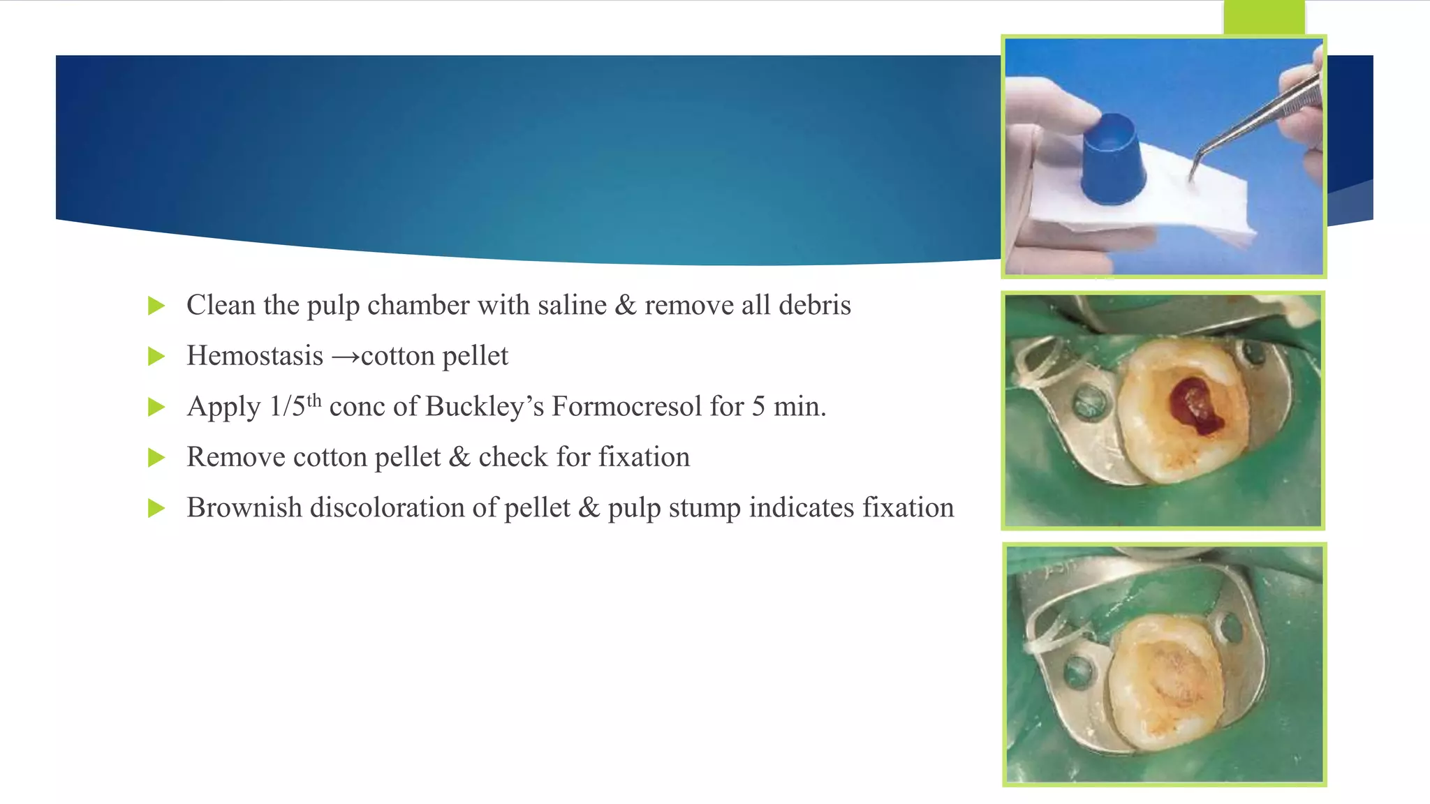 PULPOTOMY Dr. Amrutha Joy.pptx