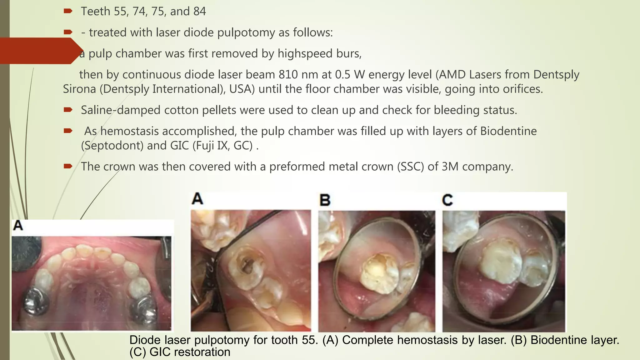 Pulpotomy management using laser diode in pediatric patient-JOURNAL ...