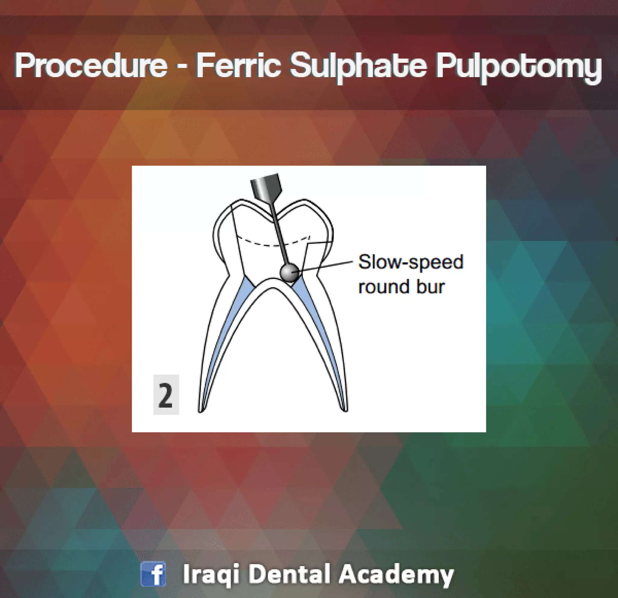 Pulpotomy Procedure for Pediatrics in Detail | PDF | Medical Health