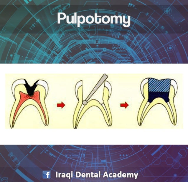 Pulpotomy Procedure In Adults at Matilda Corones blog