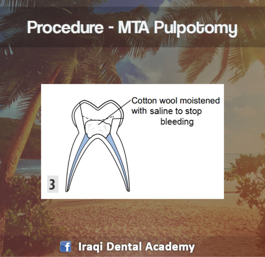 Pulpotomy Procedure for Pediatrics in Detail
