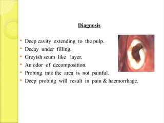 Pulp and periapical pathology presntation part 2 | PPT