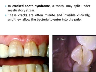 Pulp and periapical etiology | PPTX
