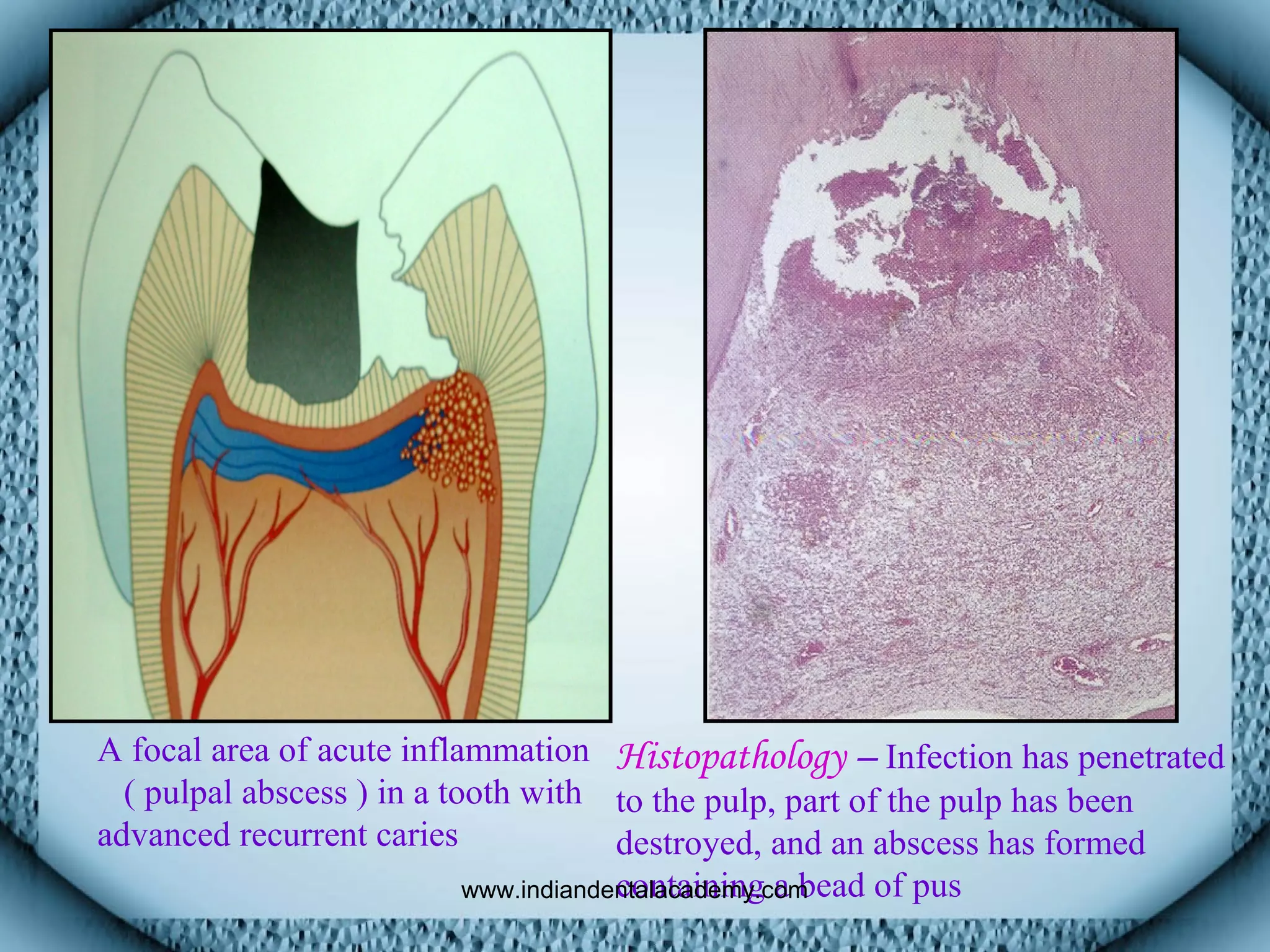 PULP AND PERIAPICAL DISEASES-2 / oral surgery courses | PPT | Dental ...