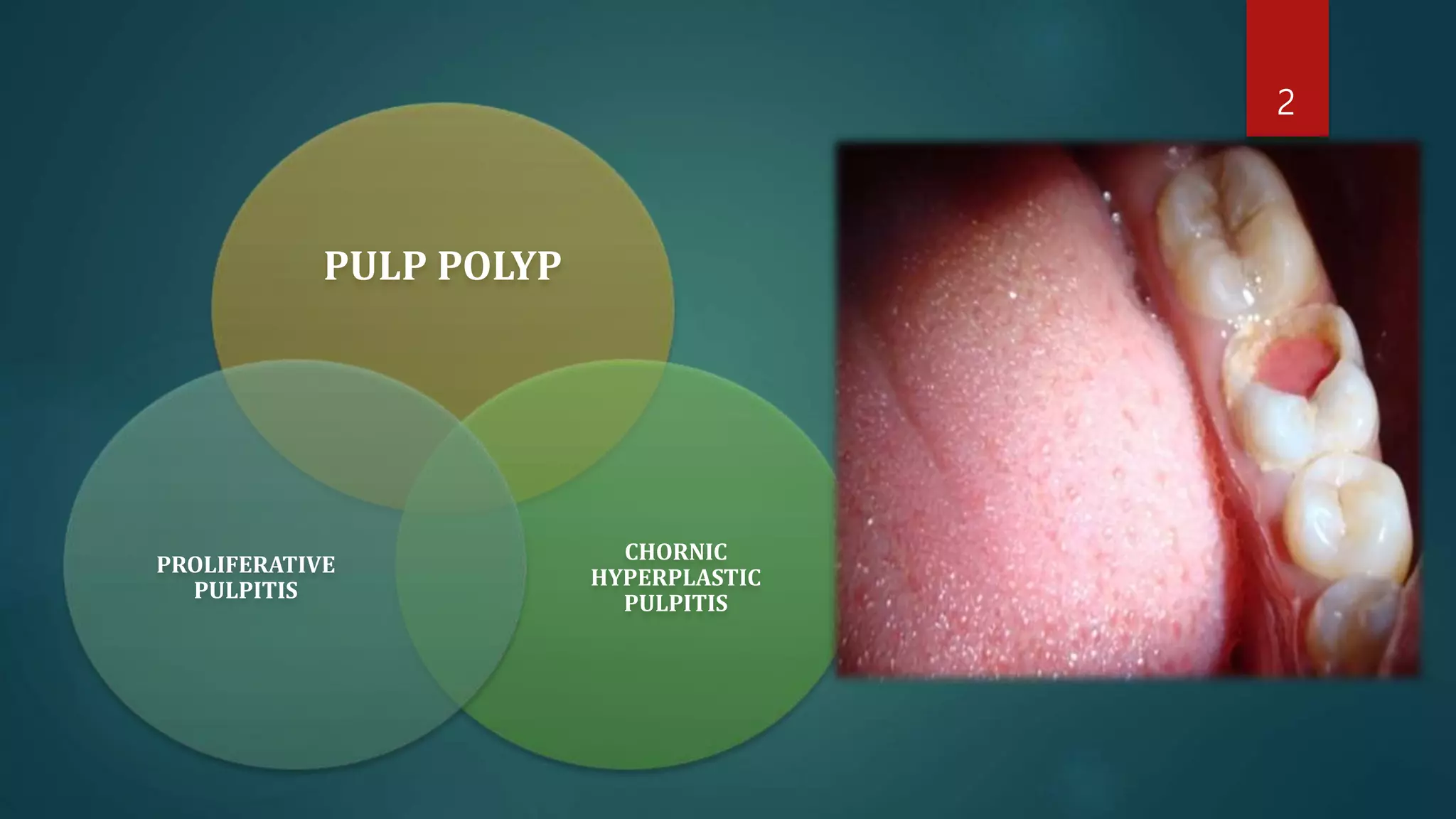 Pulp polyp ...Dr.Anubhuti | PPTX