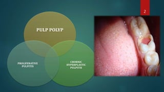 Pulp polyp ...Dr.Anubhuti | PPTX