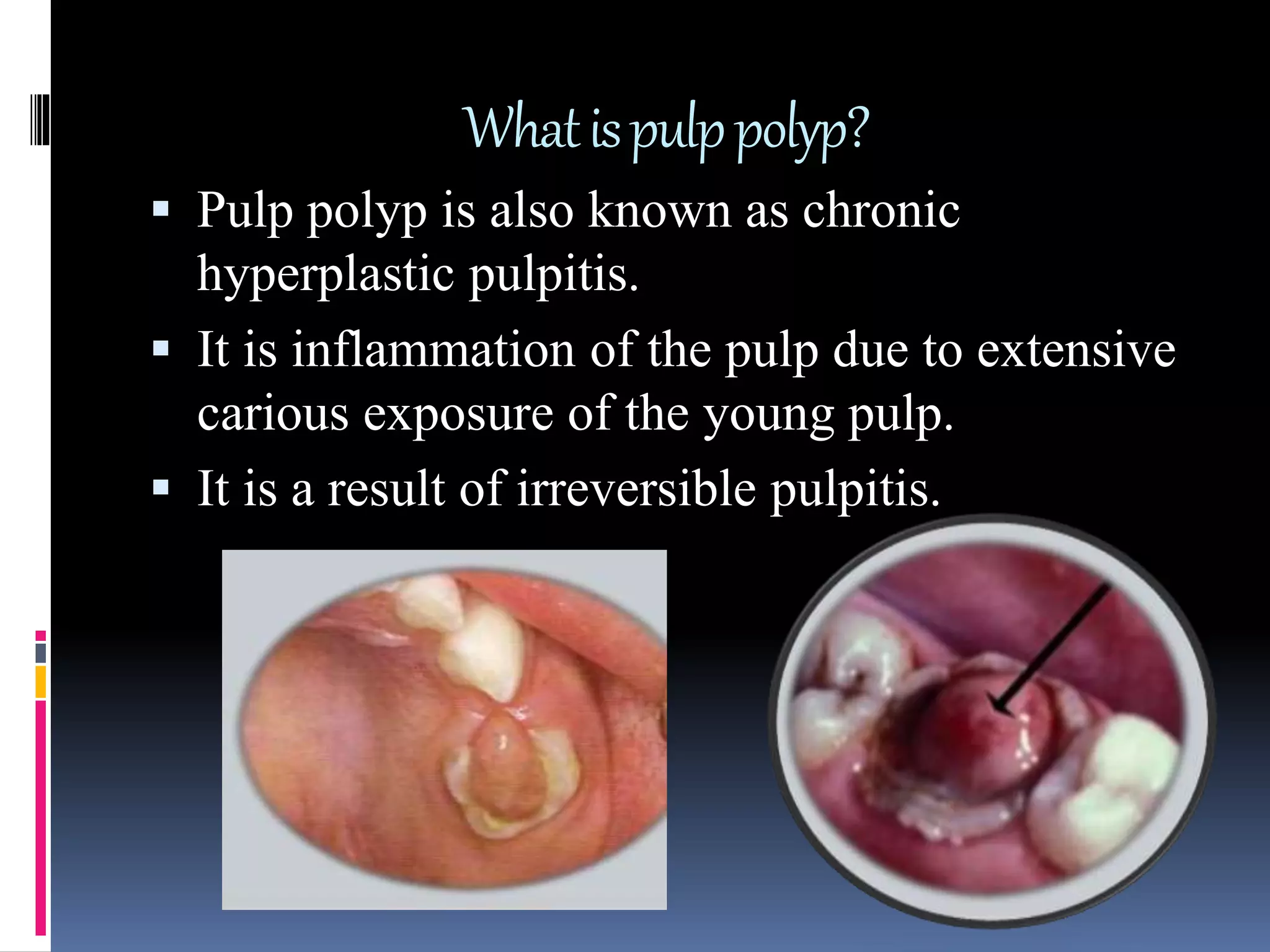 Pulp polyp and gingival polyp | PPTX