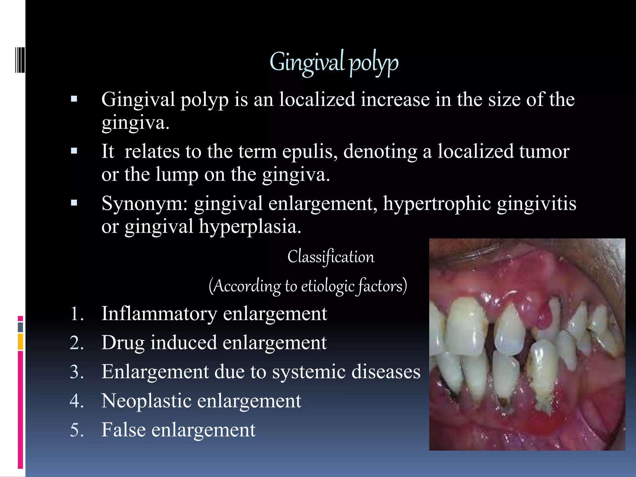 Pulp polyp and gingival polyp | PPTX