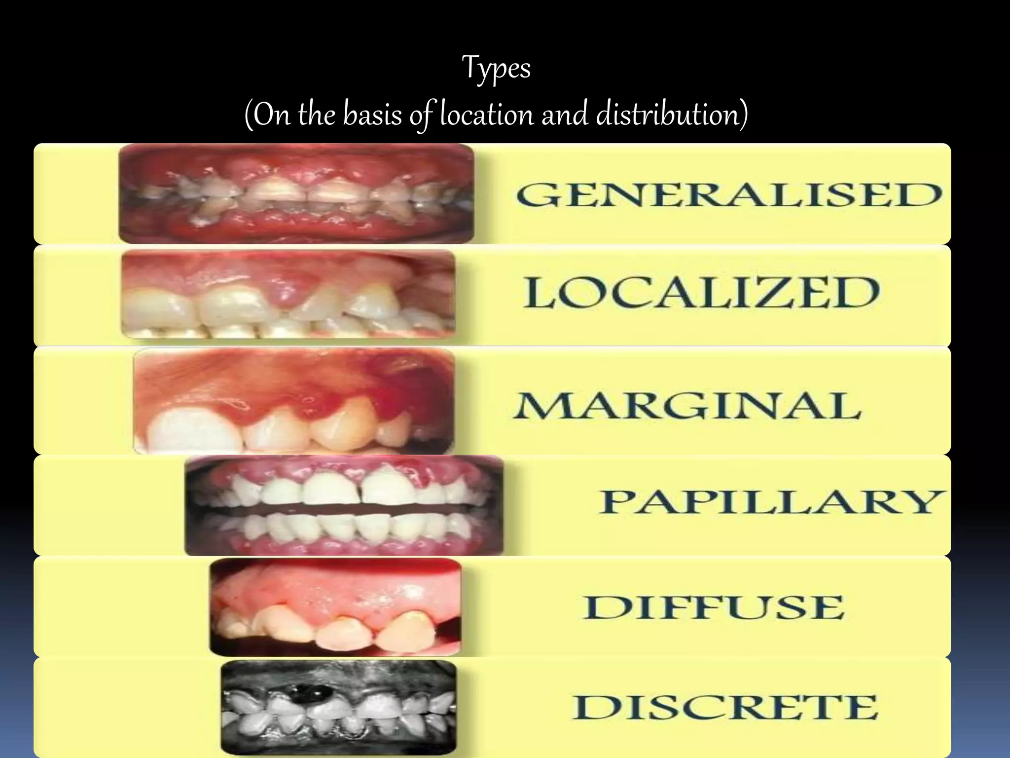 Pulp polyp and gingival polyp | PPTX