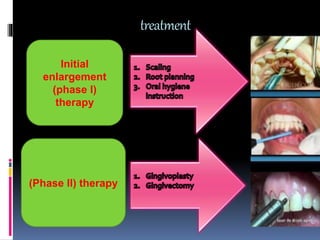 Pulp polyp and gingival polyp | PPTX