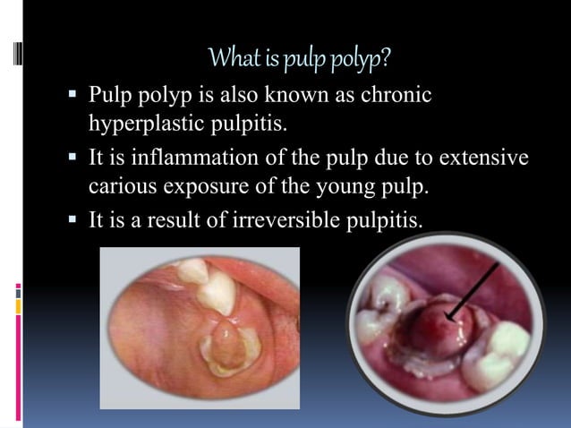 Pulp polyp and gingival polyp | PPTX