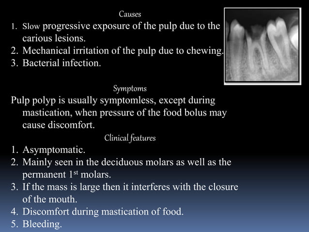 Pulp polyp and gingival polyp | PPTX