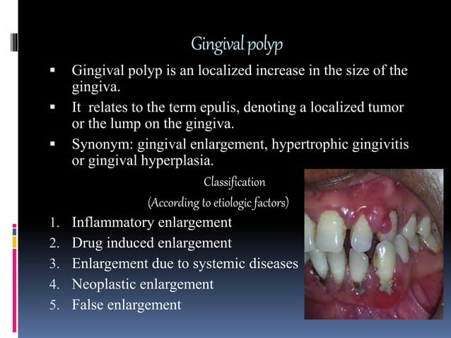 Pulp polyp and gingival polyp | PPTX