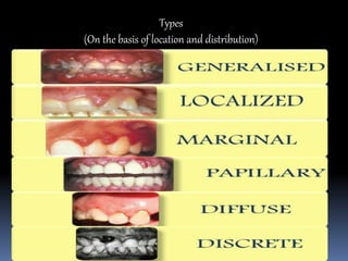 Pulp polyp and gingival polyp | PPTX