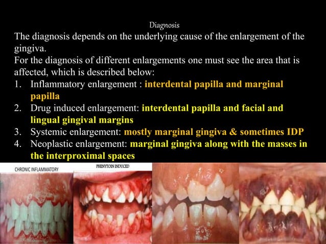 Pulp polyp and gingival polyp