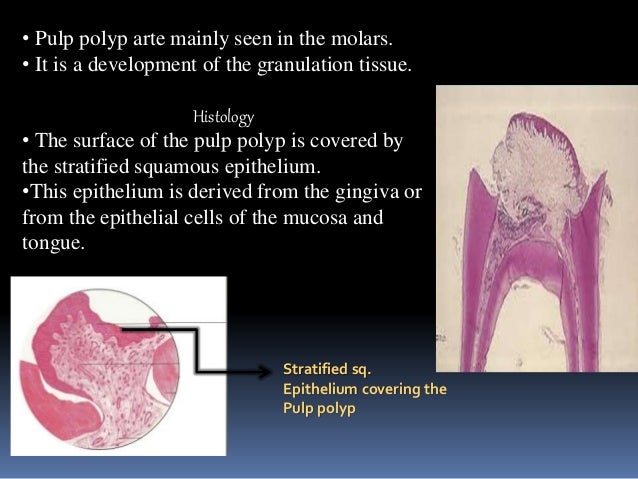 Pulp polyp and gingival polyp