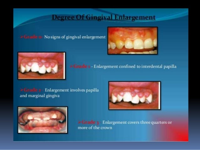 Pulp polyp and gingival polyp