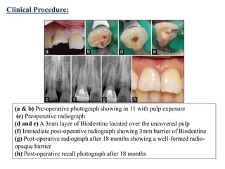 Pulp protection | PPTX