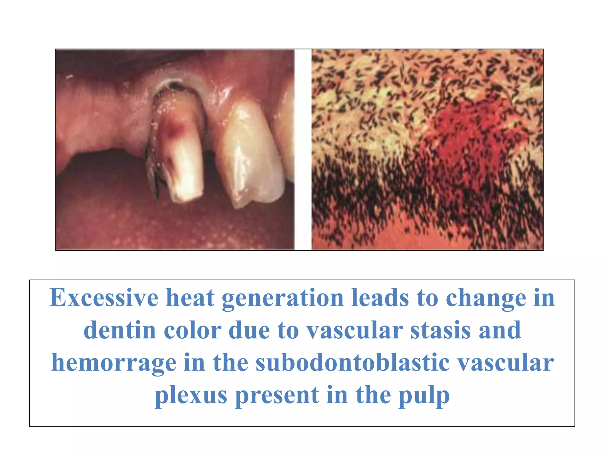 Pulp protection | PPTX