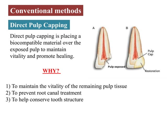 Pulp protection | PPTX