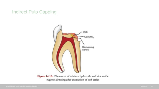 Pulp protection during operative dentistry treatment by dr. ebsa | PPTX