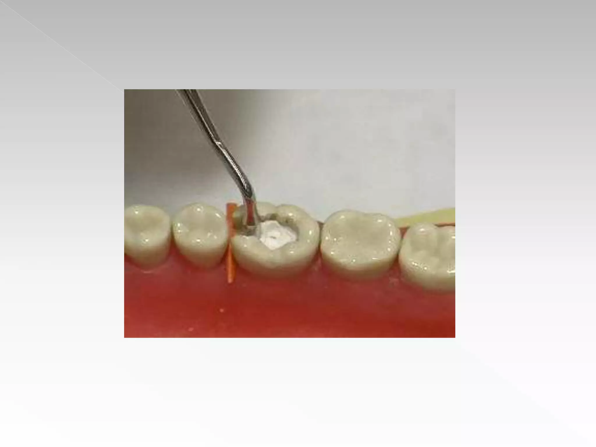 Pulp protection in operative dentistry | PPTX