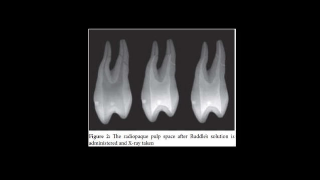 Internal Anatomy of Pulp cavity | PPTX | Dental Health | Diseases and ...