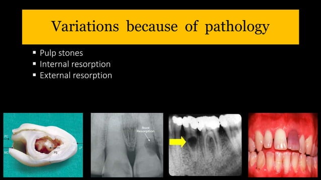 Internal Anatomy of Pulp cavity | PPTX | Dental Health | Diseases and ...