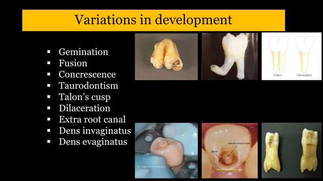 Internal Anatomy of Pulp cavity | PPTX | Dental Health | Diseases and ...