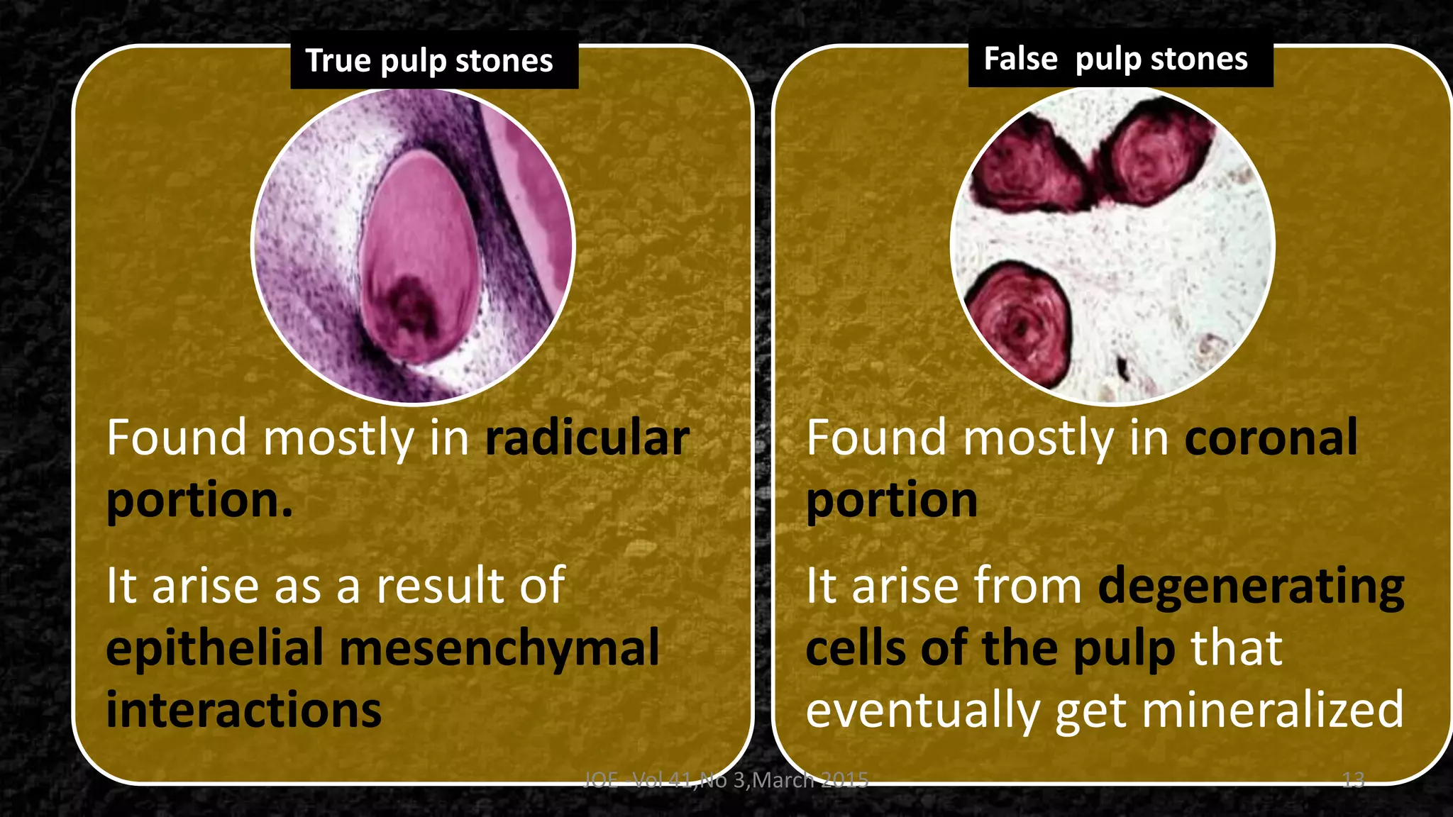 Pulp stone | PPTX
