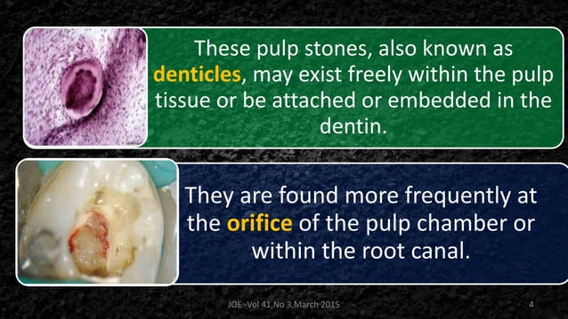 Pulp stone | PPT