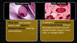 Pulp Stones